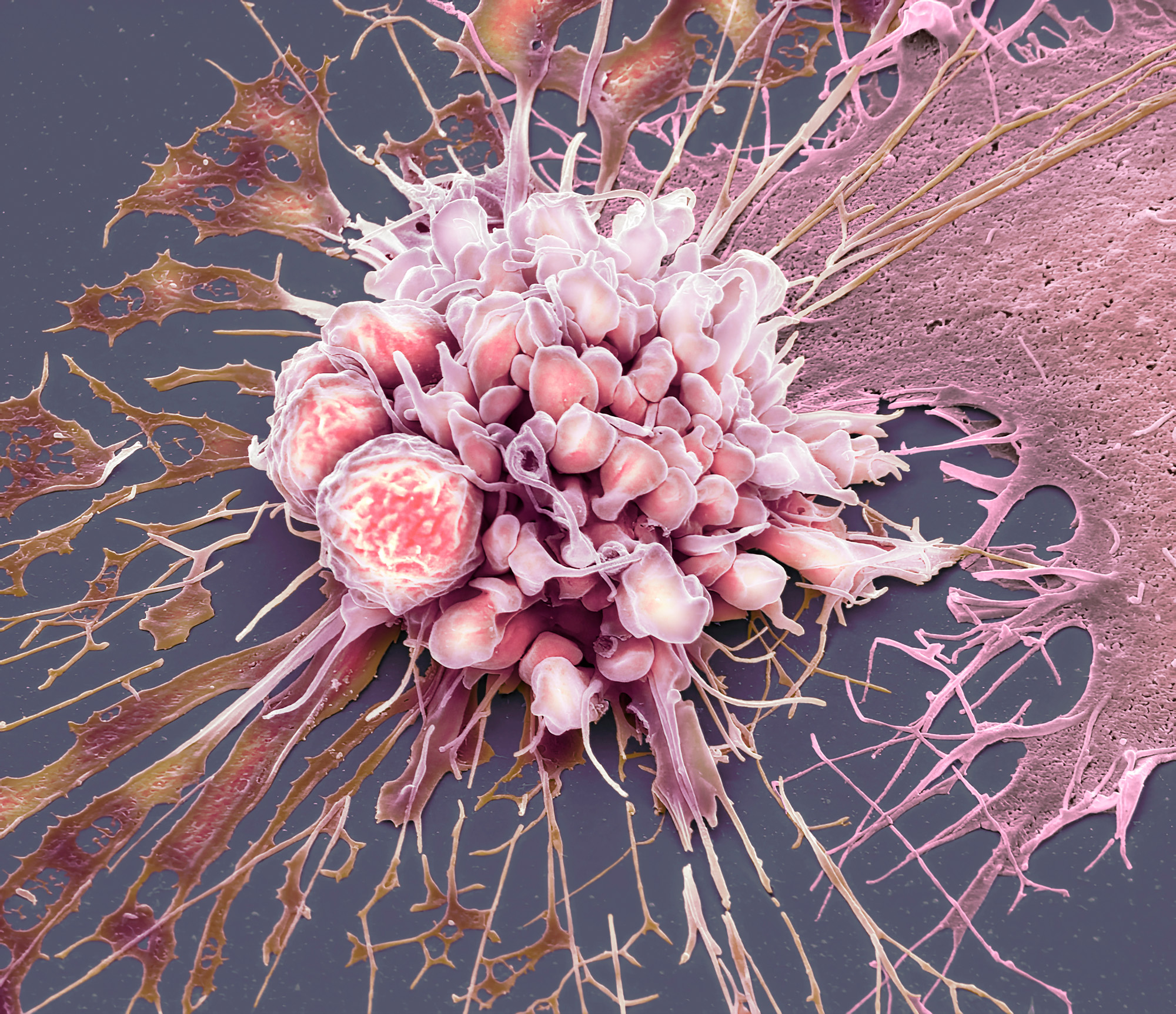 Cancer Cell Death – Science Photo Library