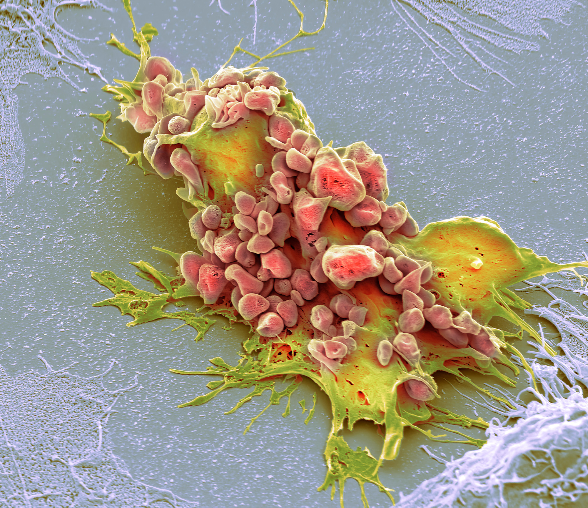 Cancer Cell Death – Science Photo Library
