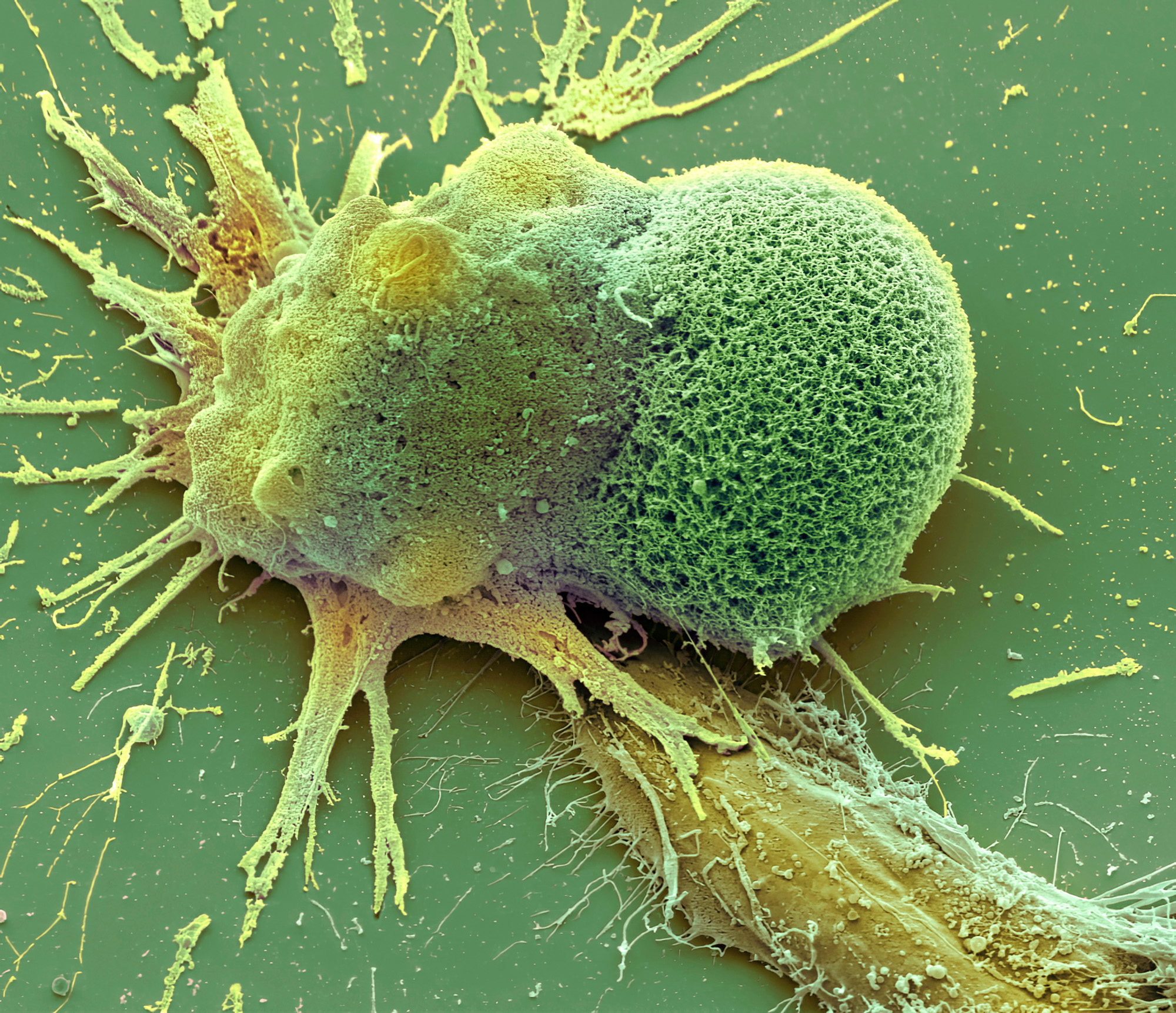 Cancer Cell Death – Science Photo Library