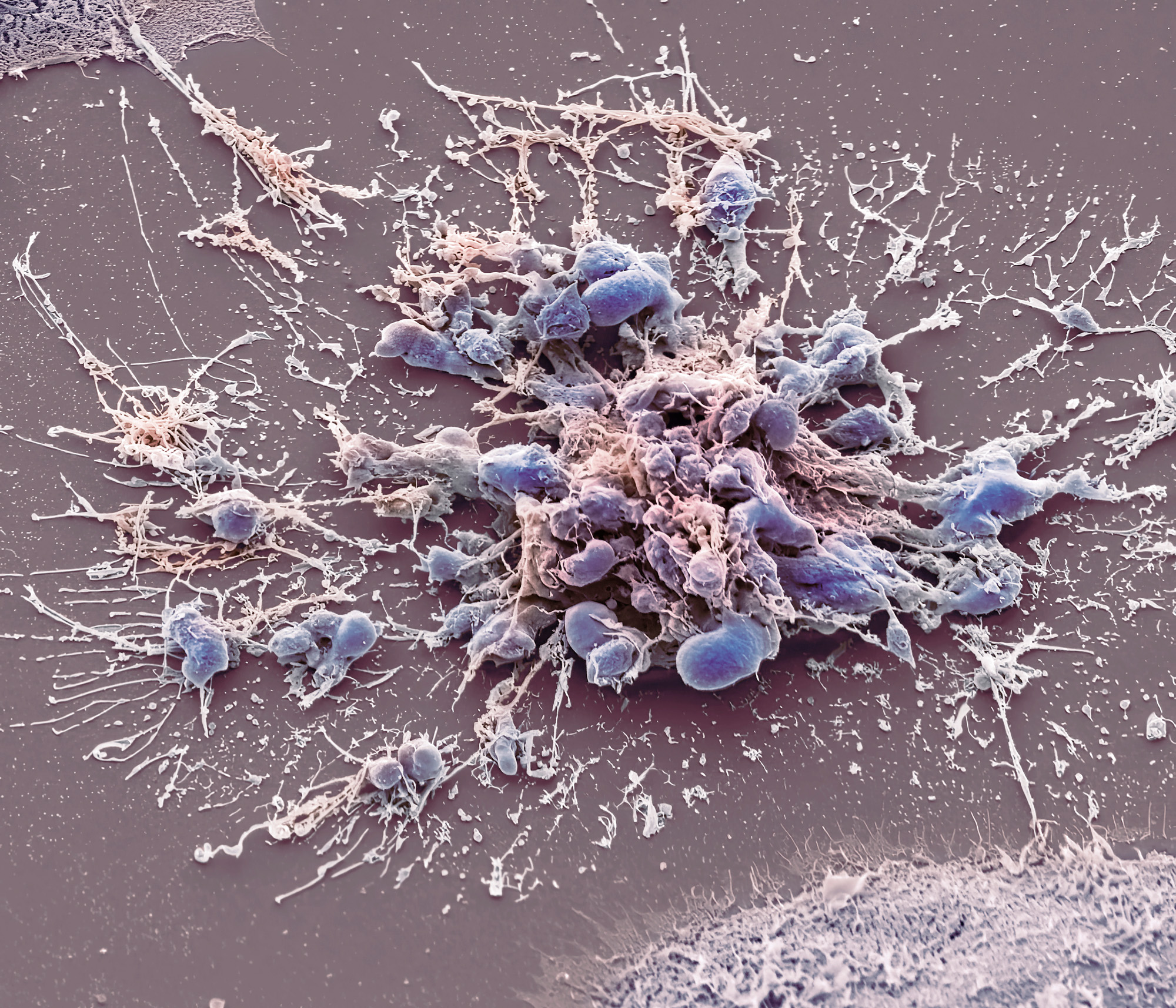 Cancer Cell Death – Science Photo Library